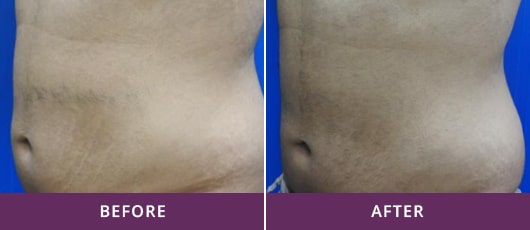 Accent Prime | Love Your Shape